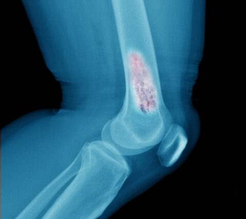 About Osteosarcoma | Osteosarcoma Collaborative