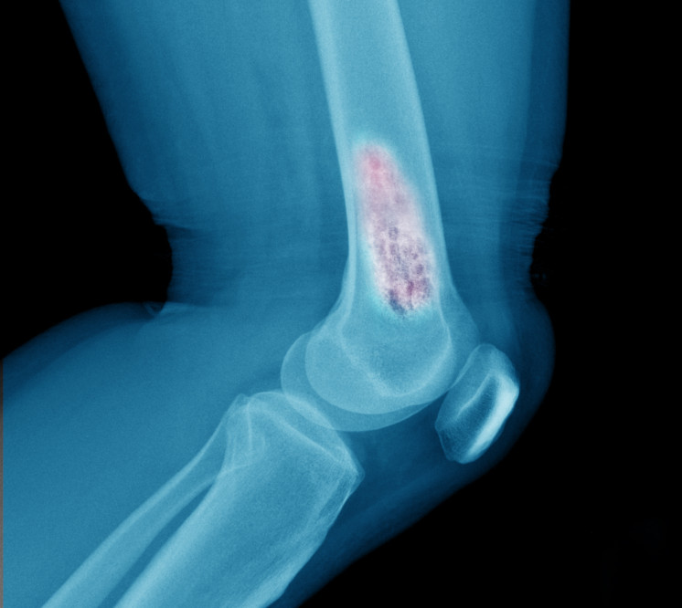 About Osteosarcoma | Osteosarcoma Collaborative